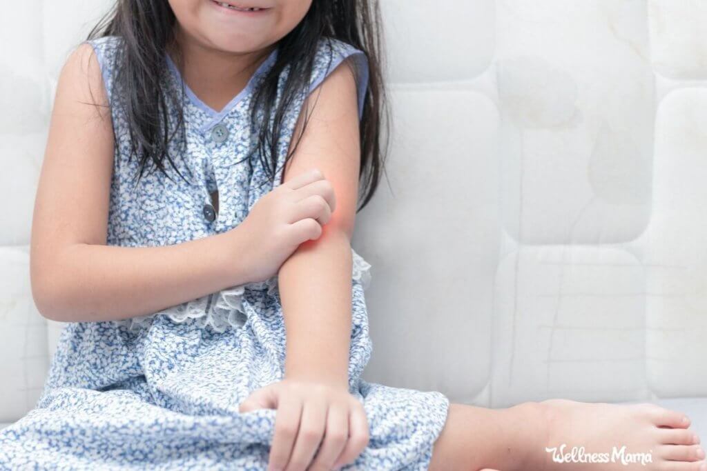 7 Natural (and Easy!) Remedies for Eczema | Wellness Mama