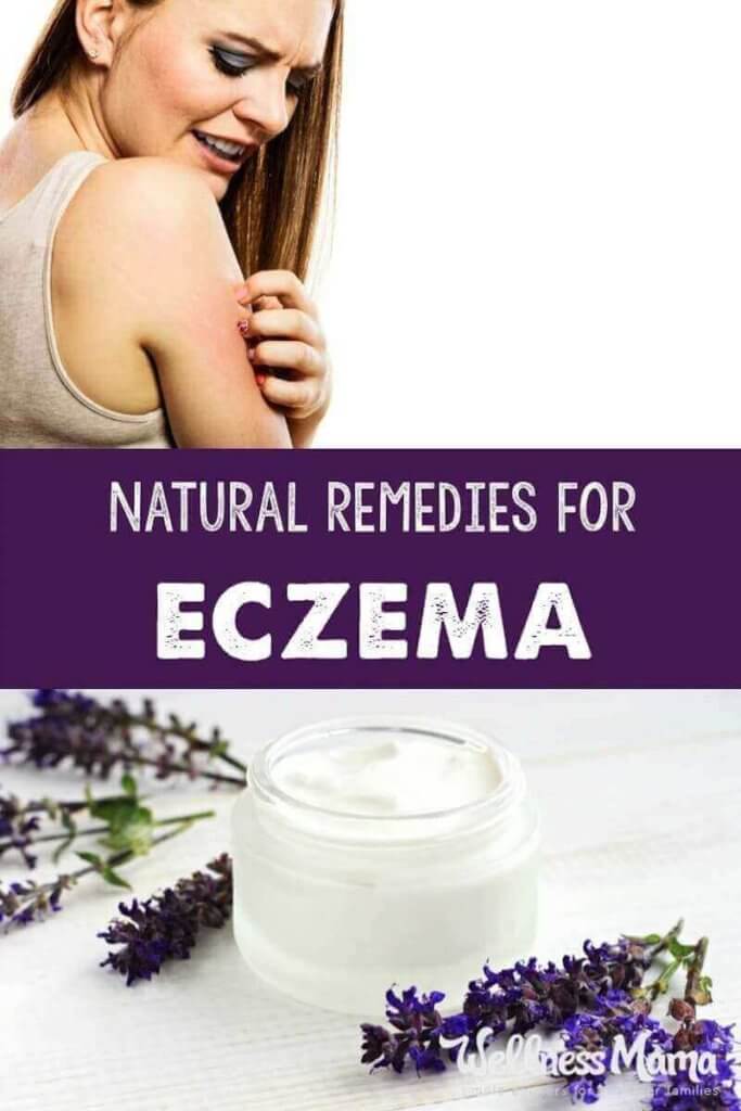 7 Natural (and Easy!) Remedies for Eczema | Wellness Mama